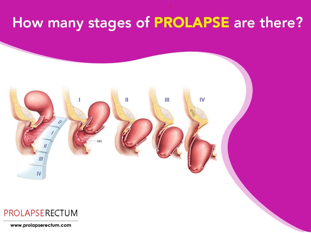 Rectal Prolapse Rectosigmoid Carcinoma Presenting As Full Thickness